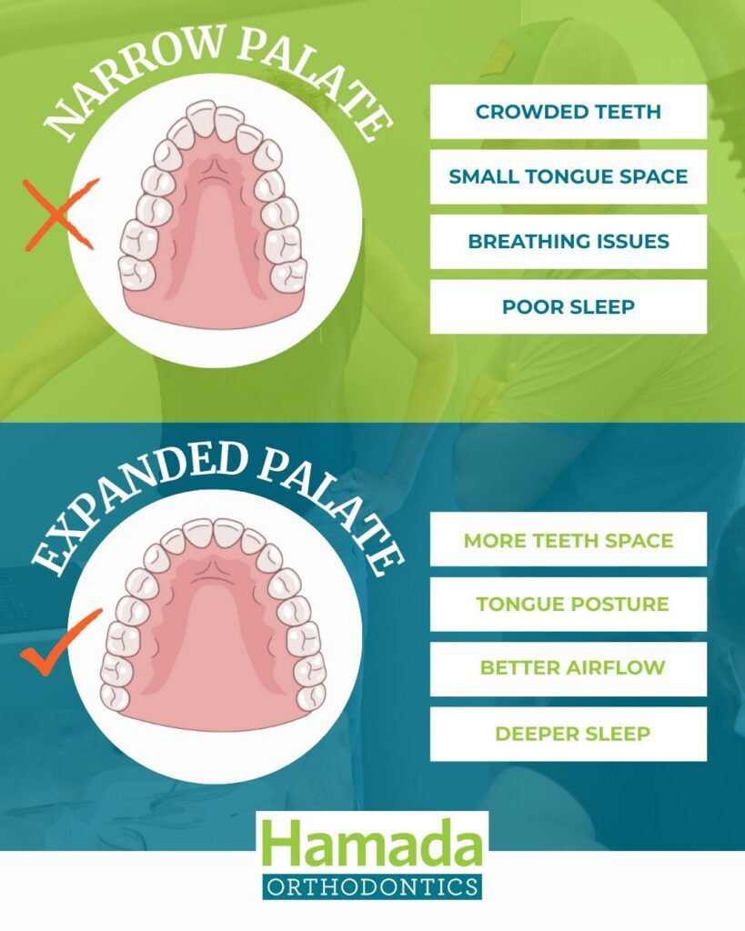 Palate Expander in Metairie, LA | Hamada Orthodontics